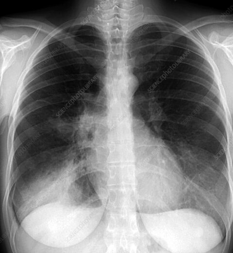 Chest Infection: Symptoms and Prevention - Asian Plus | Samakhusi ...